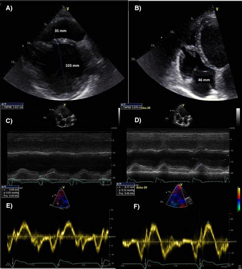 Left Ventricular Or Bi Ventricular Assist Device How Dobutamine Stress