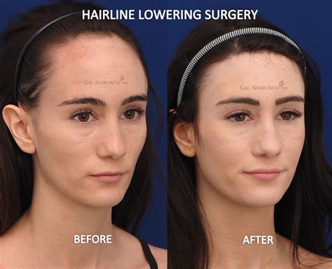 Hairline Lowering Surgery Before And After Alfred Rogers Coiffure