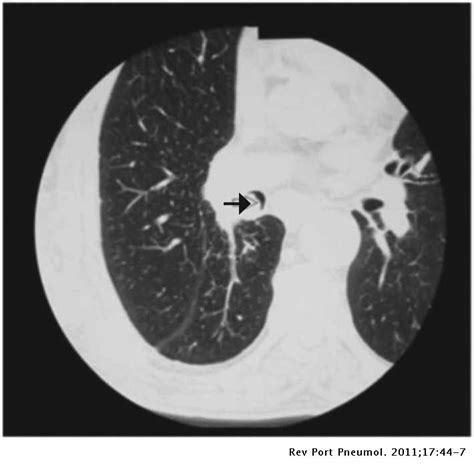 Primary Pleomorphic Sarcoma Of Lung 11 Year Survival Pulmonology