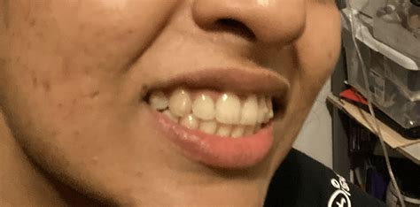 Treatment Is Done Should I Get Additional Aligners For This Slight Over Jet R Invisalign