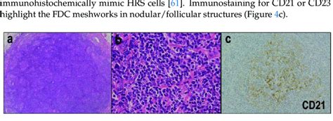 Follicular T Cell Lymphoma A Lymph Nodes Show A Nodular Follicular Download Scientific