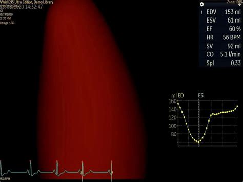 Lv Systolic Function Pptx