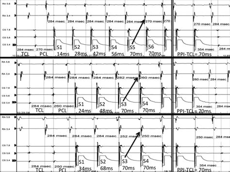 Typical Atrial Flutter Icd 10 Venturekiza