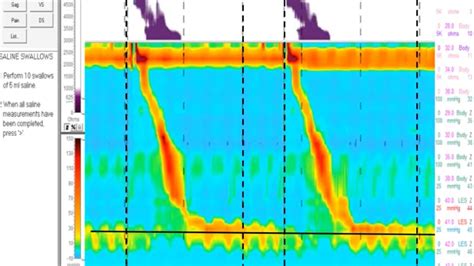 Acquisition Of Esophageal Manometry Study Using An HRiM Small Diameter Probe Diversatek University