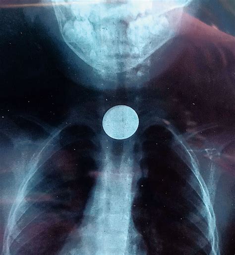 Foreign Body Removal Foreign Bodies In The Airway A Foreign Body In