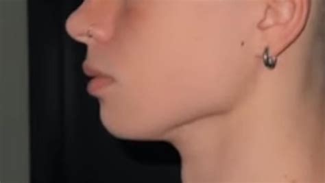 Am I Recessed R Mewing