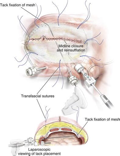 Endoscopic Component Separation Clinical Gate
