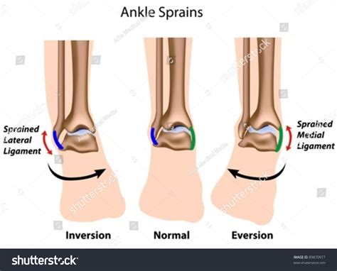 Types Ankle Sprains Stock Vector Royalty Free 89870977 Shutterstock