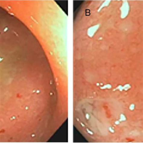 Endoscopic Appearance Of The Colonic Mucosa Showing Severe Inflammation