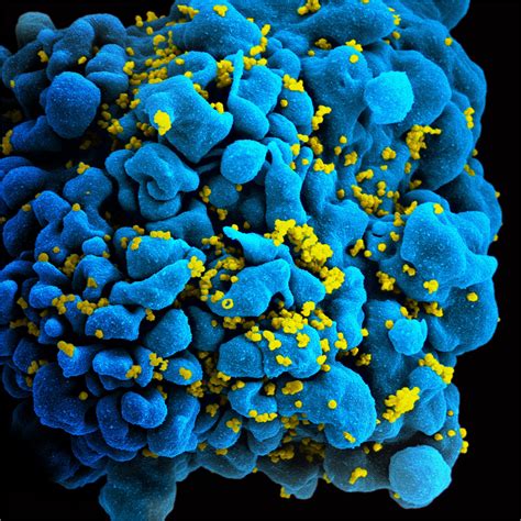 Hiv 1 Infected Cell The Image Shows A Microphotography Of An Infected
