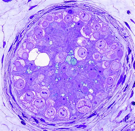Testis Neoplasia By Science Photo Library