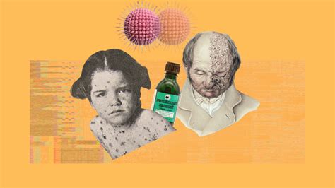 ჩუტყვავილა და ზოსტერი ერთი ვირუსის ორმაგი საფრთხე Civil Georgia