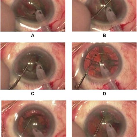 Technical Difficulty In An Ordinary Stop And Chop Technique In A Case