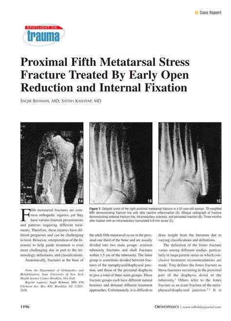 Pdf Proximal Fifth Metatarsal Stress Fracture Treated By Early Open Reduction And Internal
