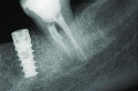 Intraoral Teeth Imaging Tooth Control Image After Months Download Scientific Diagram