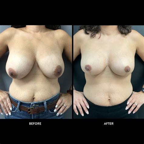 Breast Reduction Before And After Pictures Nhs