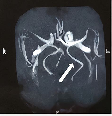 MRA Imaging Shows Age Related Changes With Hypoplastic V4 Segment Of