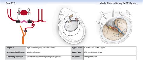 Intracranial Intracranial Bypass With Interposition Graft Neupsy Key