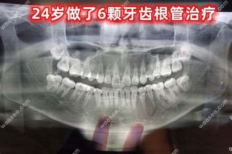 24岁做了6颗牙齿根管治疗才懂的事根管戴牙冠真的很费钱 口腔资讯 牙齿矫正网