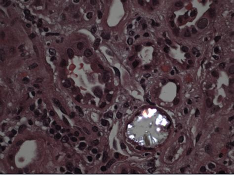 Nephron Power Topic Discussion Secondary Oxalate Nephropathy