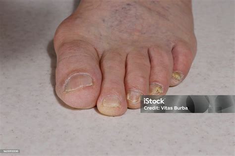 엄지발가락의 뚜렷한 곡률을 가진 인간의 발 이미지 Hellux 외반 가까이 옴에 대한 스톡 사진 및 기타 이미지 가까이 옴 곡선 굽은 Istock