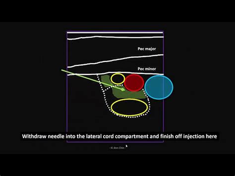 Infraclavicular Nerve Block Critical Structures In The Needle Path Of