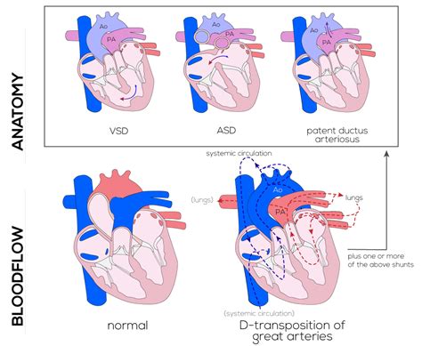 Congenital Defects Tutorial Congenital Heart Defects Atlas Of Human Cardiac Anatomy