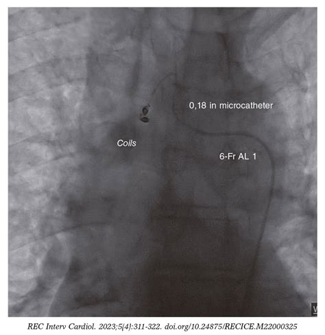 Massive Hemoptysis Selective Embolization Of Bronchial Artery Left Pulmonary Artery Fistula