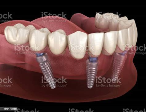 하악 보철은 임플란트에 의해 지원되는 4 개의 시스템에 모두 인간의 치아와 의치 개념의 의학적으로 정확한 3d 그림 임플란트에 대한 스톡 사진 및 기타 이미지 Istock