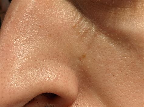 Sebum Plug Nose