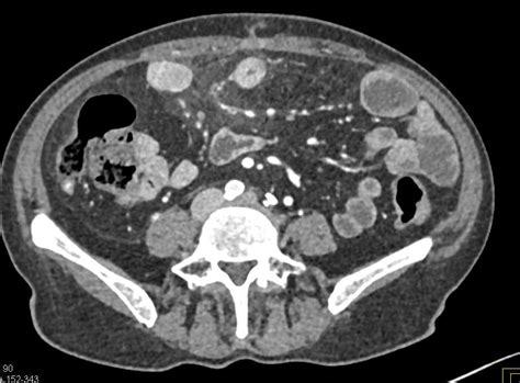 Gastrojejunostomy With Recurrence At Anastomosis Small Bowel Case