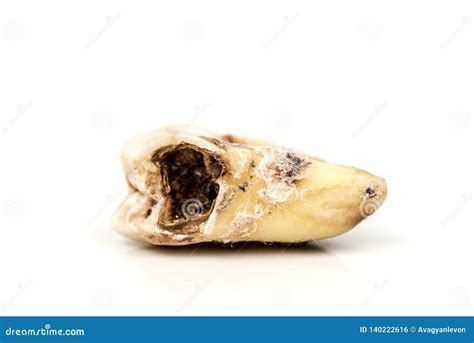 Decayed Wisdom Tooth