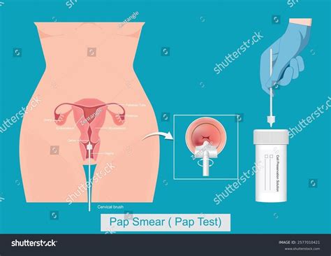 Cervical Cancer Screening Pap Test Pap Stock Vector Royalty Free