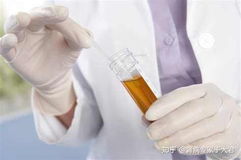 尿中有泡沫是糖尿病的表现还是肾功能出了问题 知乎