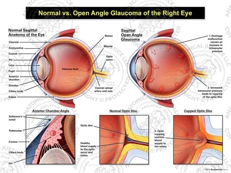 Normal Vs Open Angle Glaucoma Of The Right Eye