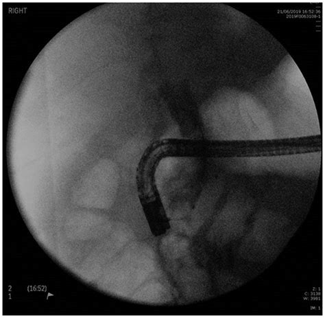 Endoscopic Retrograde Cholangiopancreatography Download Scientific Diagram