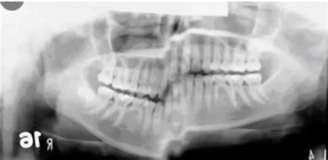 Panoramic Errors With Pictures Flashcards Quizlet