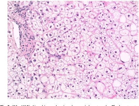 Figure 3 From Prognostic Implication Of Liver Histology In Patients With Nonalcoholic Fatty