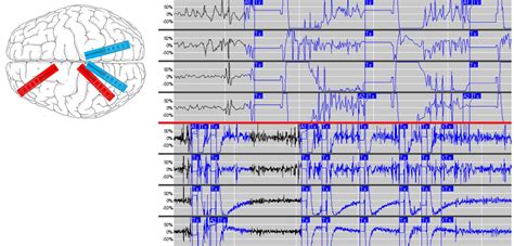 Responsive Neurostimulation For Management Of Refractory Precuneus