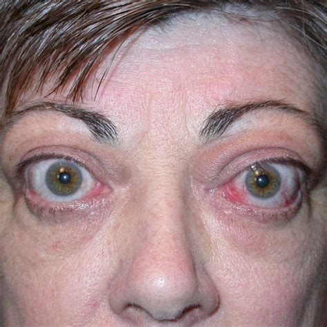 Before And After Thyroid Eye Disease