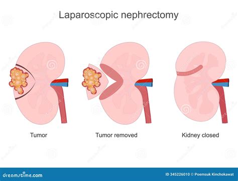 Nephrectomy Is A Major Procedure Performed Stock Illustration Illustration Of Inflammation