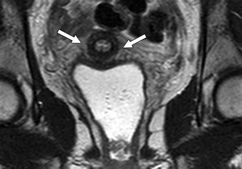 Parametrium Radiology