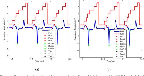 Figure 1 From Ecg Segmentation And Fiducial Point Extraction Using Multi Hidden Markov Model