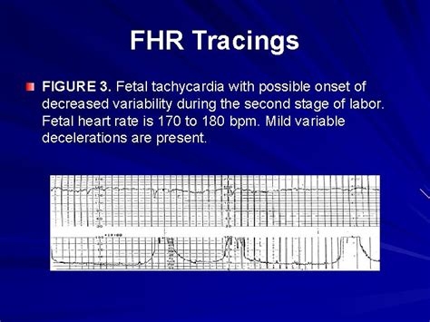 Fetal Hr Tracings Fetal Heart Rate Fhr Is