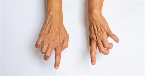 Physiotherapy Clinic Managing Spasticity Causes Symptoms And Treatment