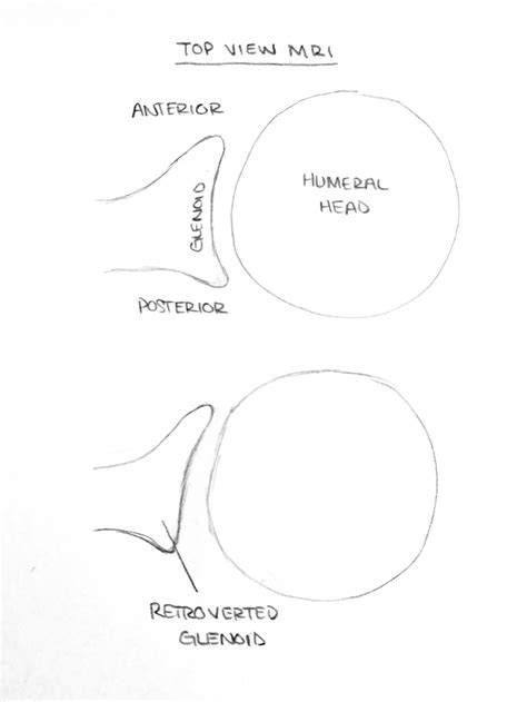 Aotw Can Glenoid Retroversion Predict Labral Tears
