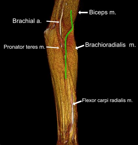 Radial Nerve At The Forearm 3d Atlas Of Neurological Surgery