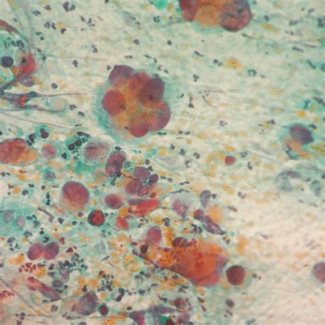 Texas Society Of Pathologists Initial Differential Was Between Invasive Ductal Carcinoma With