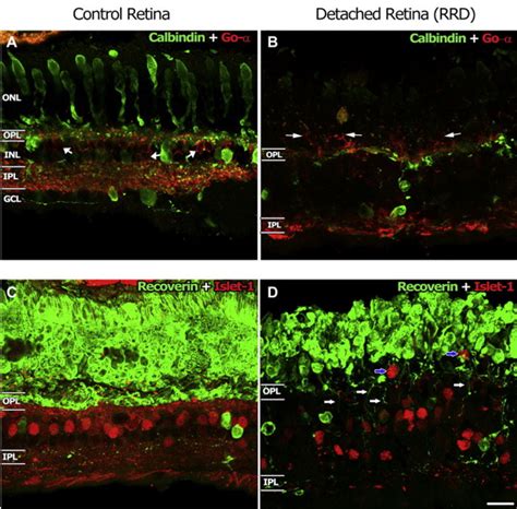 Functional And Anatomical Remodeling In Human Retinal Detachment Webvision