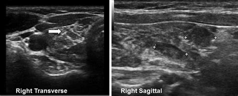Pattern Recognition Diffuse Thyroid Disease Radiology Key